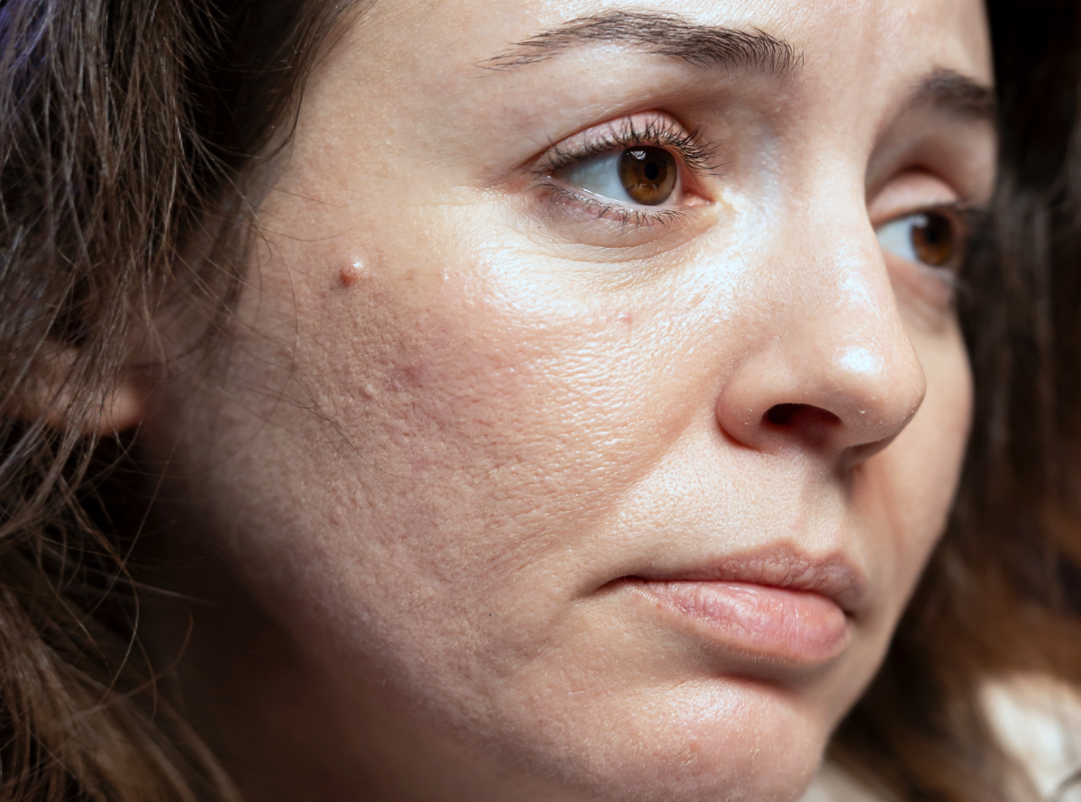 5 Ways Stress Shows Up On Your Skin – Sun Coast Sciences